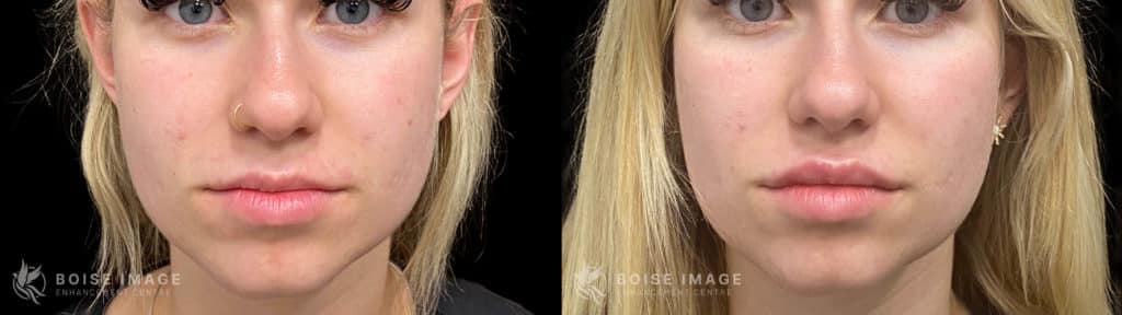 Natural Looking Lips | Blog | Boise Image Enhancement Centre