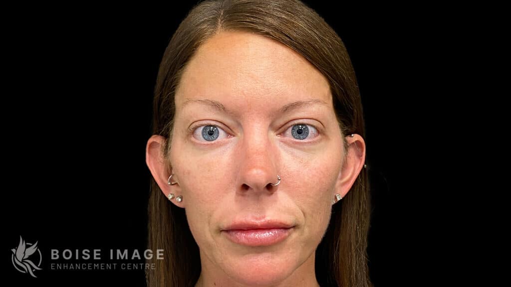 Apple Cheek Filler | Blog | Boise Image Enhancement Centre