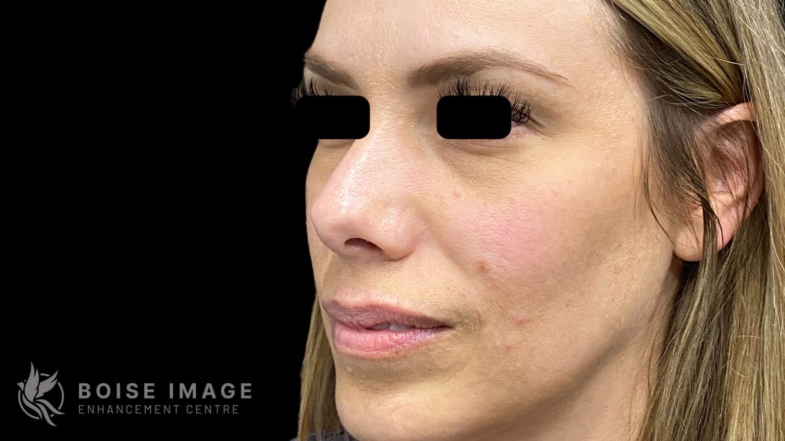 Dermal Fillers - Boise Image Enhancement Centre