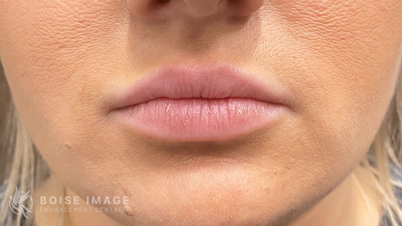 Lip Fillers Boise Image Enhancement Centre