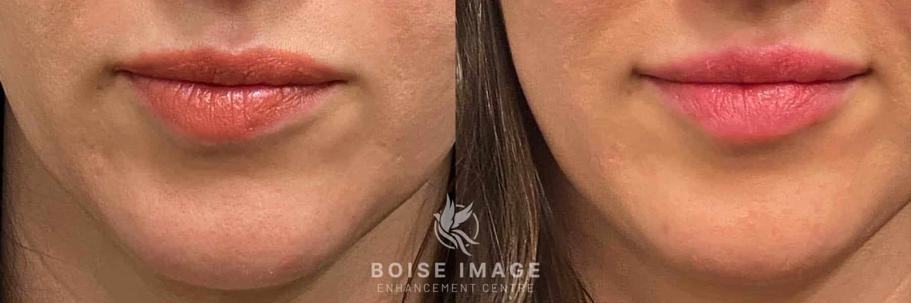 Restylane Kiss | Blog | Boise Image Enhancement Centre